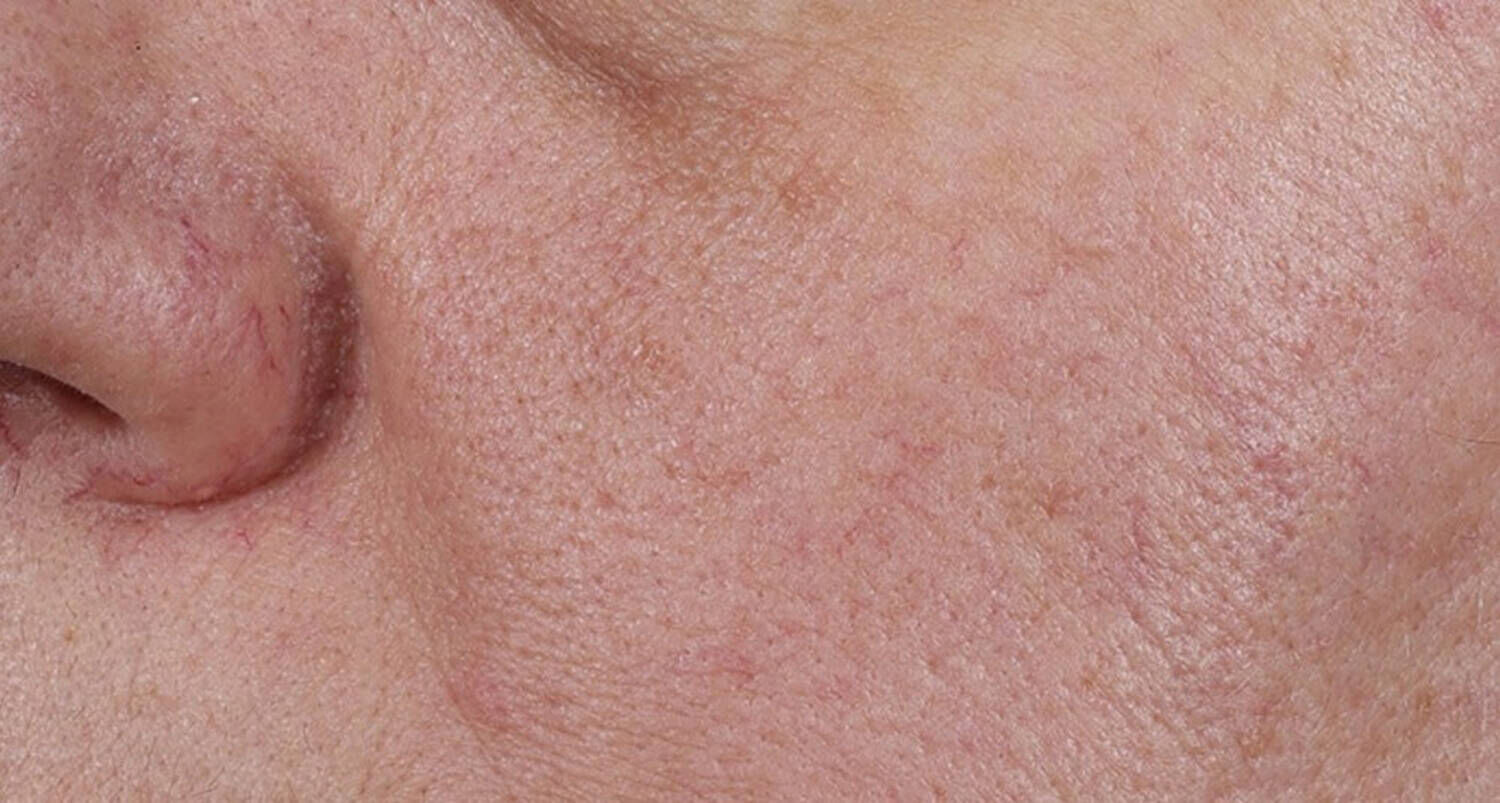 Génifique Ultimate Serum Skin Recovery - Refillable - Lancôme